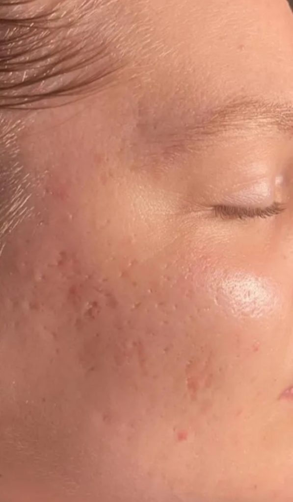 Acne Treatment Results Grand Rapids | Skin Renew Co.