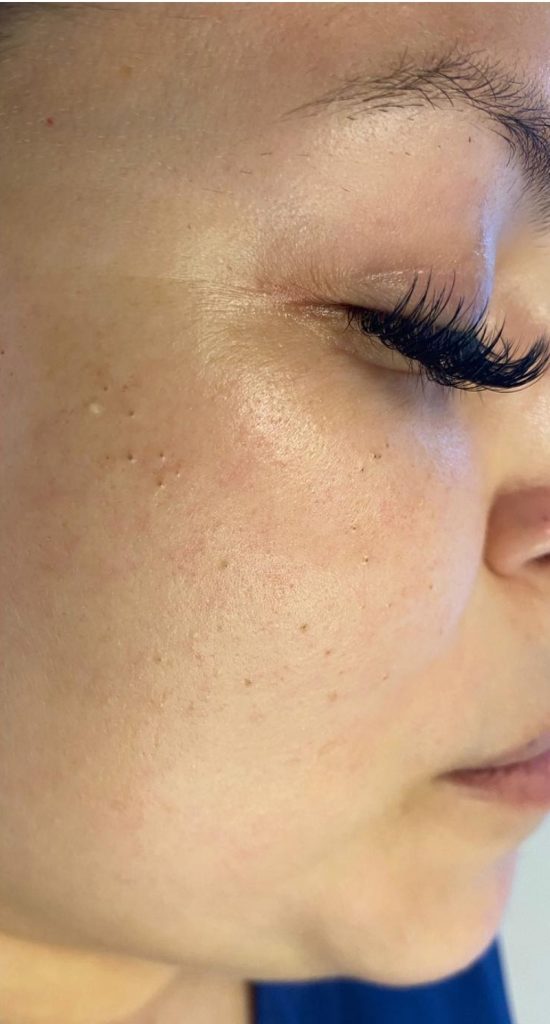 Acne Treatment Results Grand Rapids | Skin Renew Co.